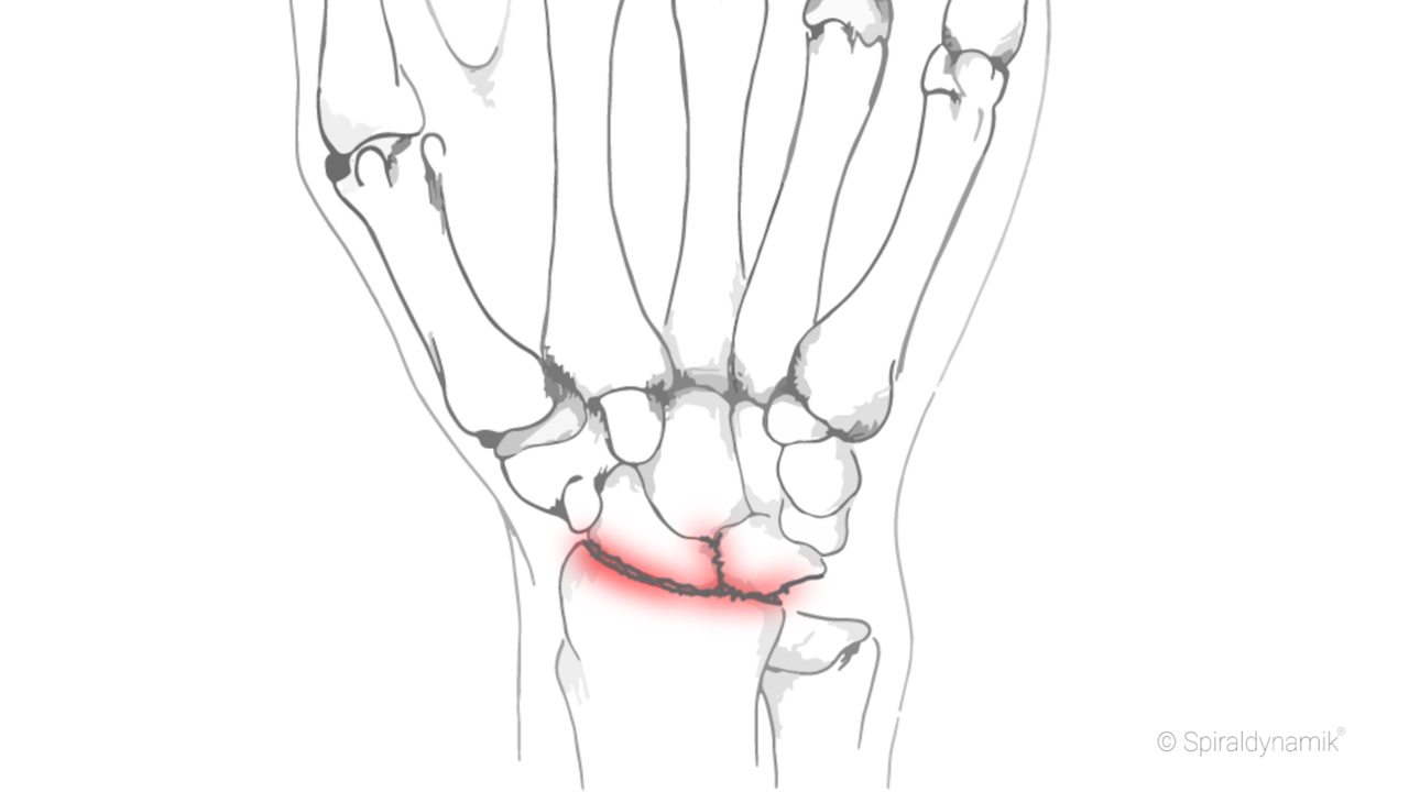 Therpie Handgelenk-Arthrose